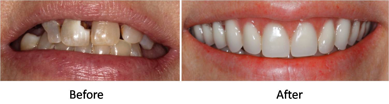 Dentures Downtown Dallas TX | Dallas Dental Arts